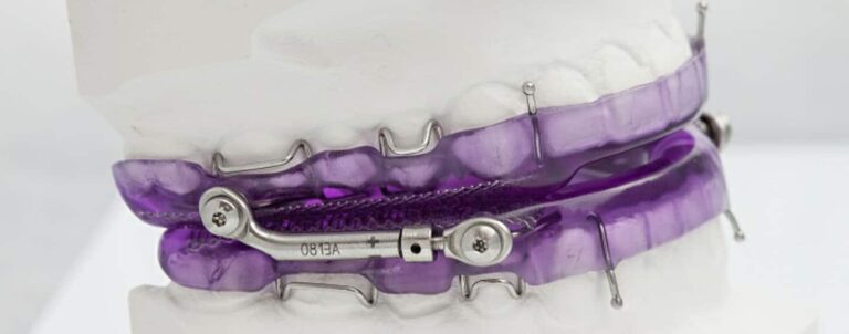 HERBST Appliance - Apollo Dental